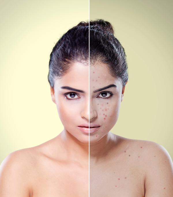 Acne Scar Treatment-Dr.Grace Skin, Hair, and Laser Center